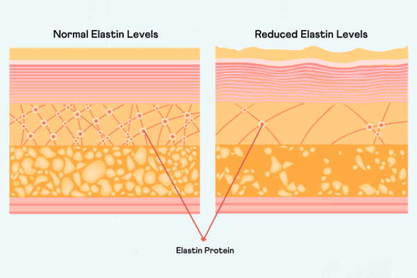 How It Works: Stretch Marks And Genetics