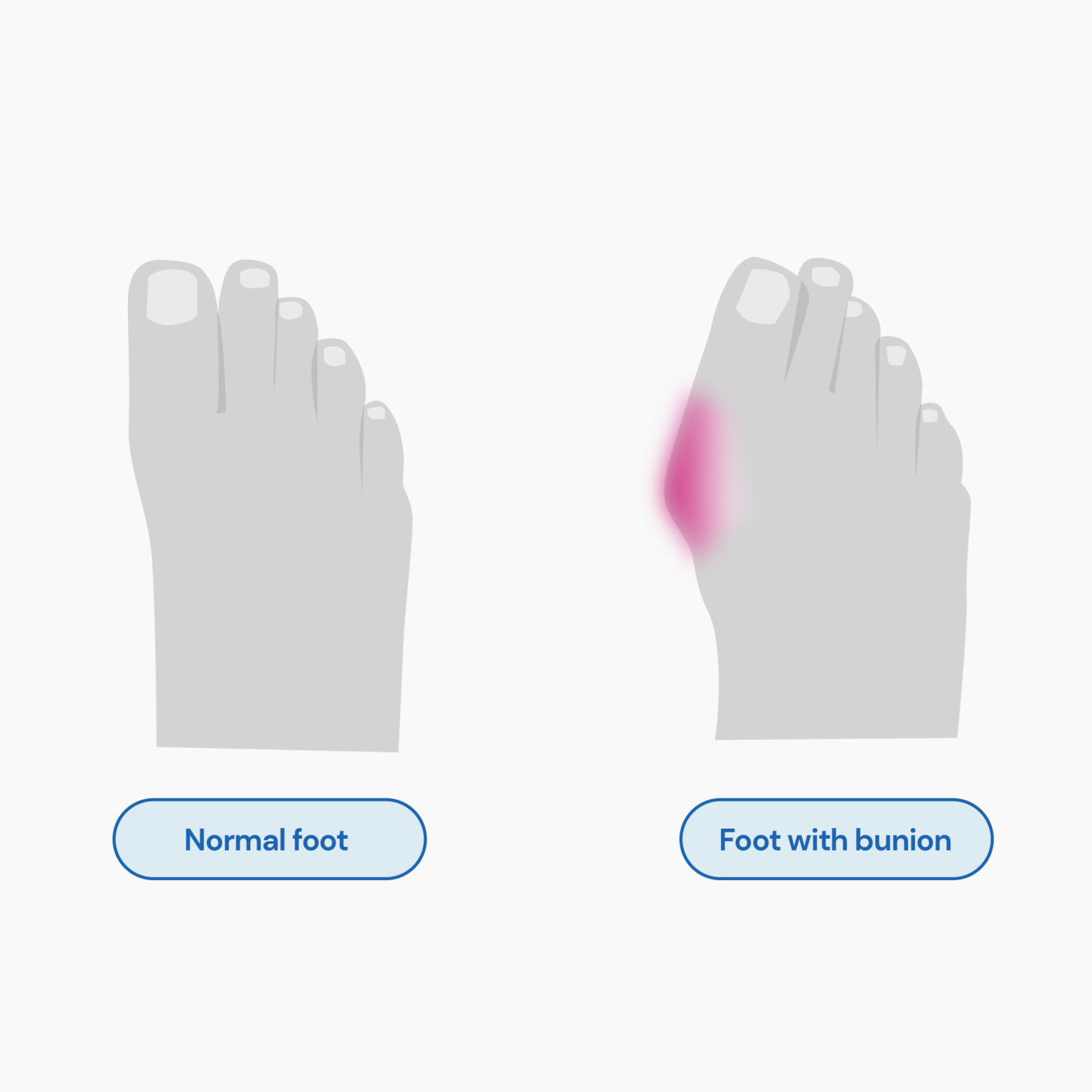 Are Bunions Genetic? Here’s How You May Inherit Them