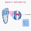 Is Gout Hereditary? How To Identify Your Genetic Risk?