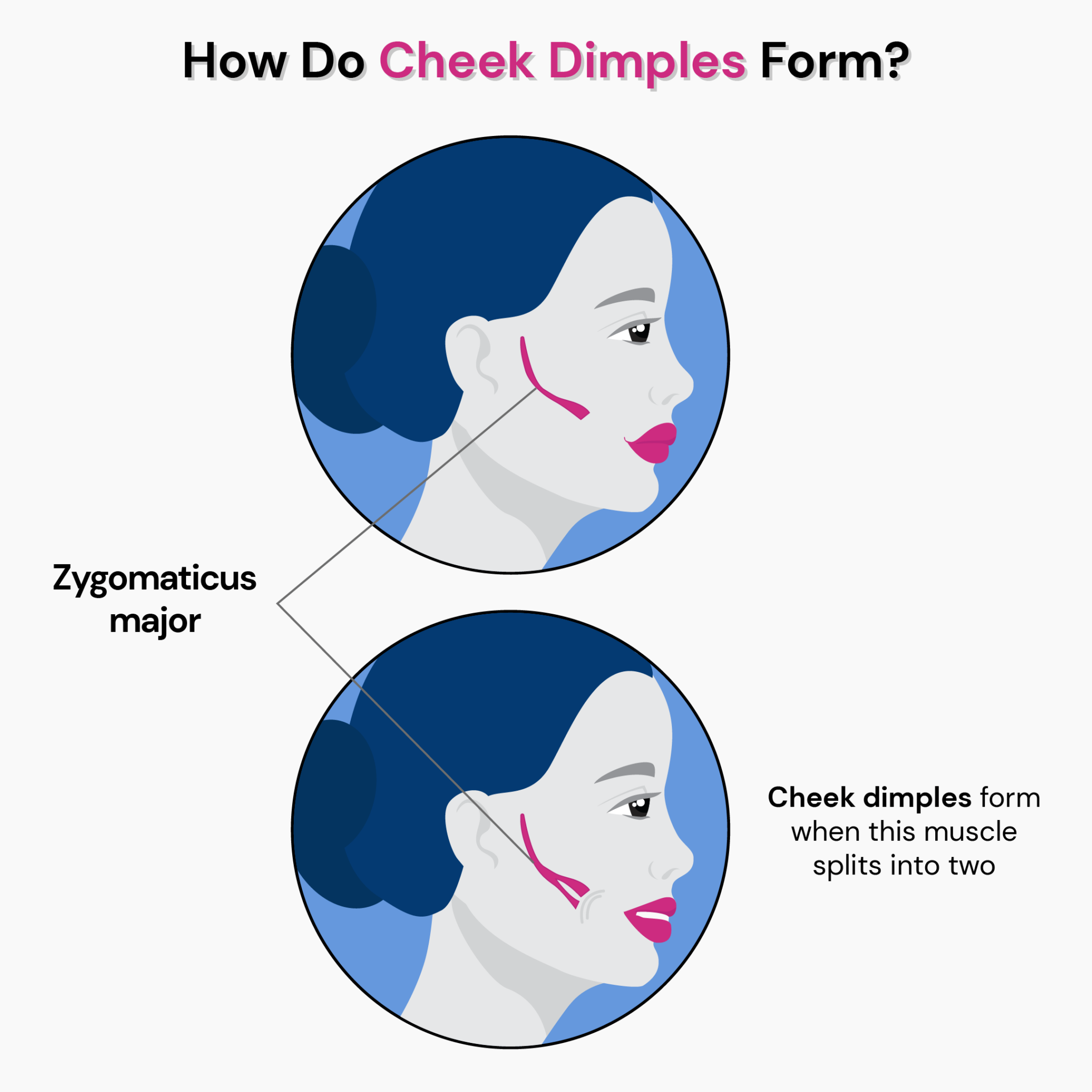 What Gene Causes Dimples When Smiling?