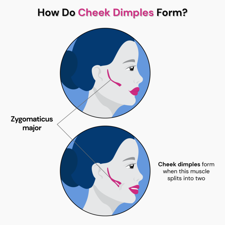 What Gene Causes Dimples When Smiling?