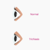 Double Eyelashes (Distichiasis) - Why Does It Happen?